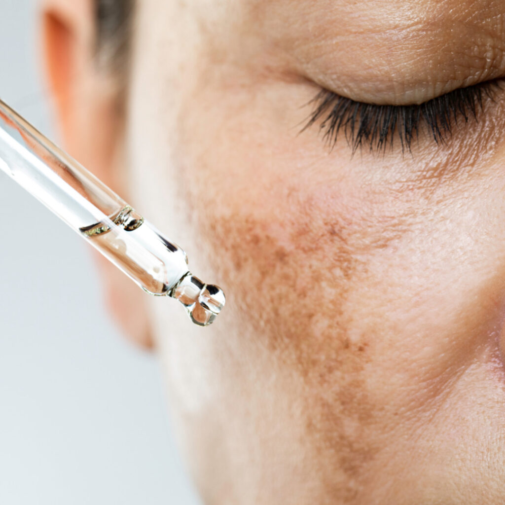 Melasma e câncer de pele em fototipos mais altos. - Dra Melina ...